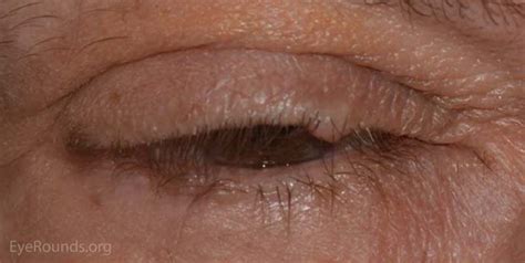 Benign Lesions Of The External Periocular Tissues