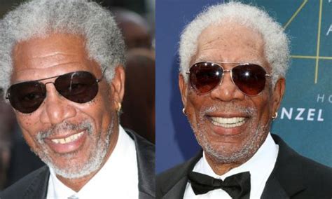 Cher Lloyd Teeth Before And After