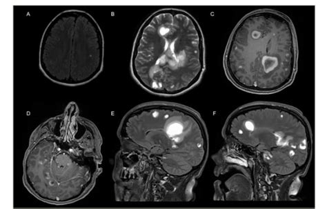 Paradoxical Tumefactive Worsening Of Multiple Sclerosis After
