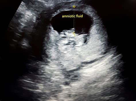 Amniotic Fluid Is Sterile In Uncomplicated Term Pregnancies