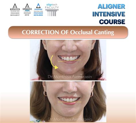 เคสนี้ แก้ไข Occlusal Canting Aligner Intensive Facebook