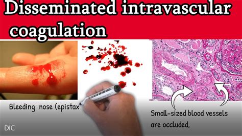 Disseminated Intravascular Coagulation