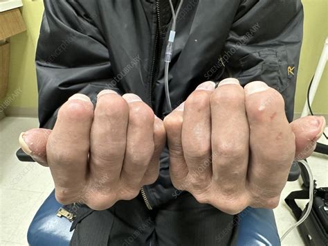 Calcinosis Knuckles