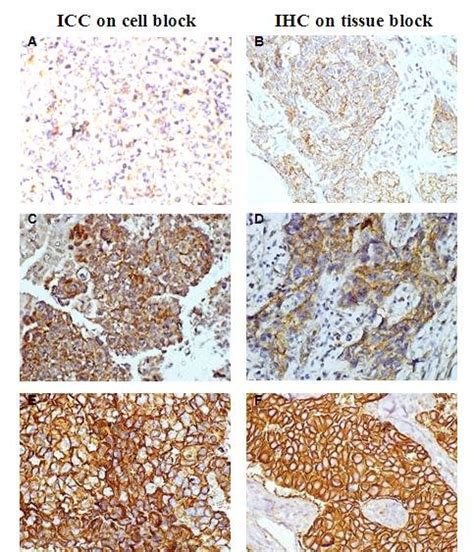 Her2neu Icc On Cell Block Compared With Ihc On Histology Specimen Of