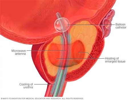 Benign Prostatic Hyperplasia BPH Symptoms Diagnosis 40 OFF