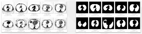 Github Yanasantslungcomputedtomographyimagesegmentation Lung