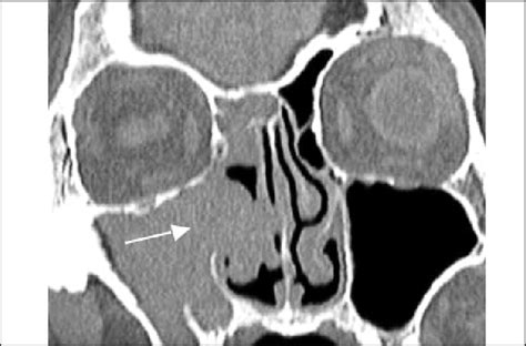 Coronal Ct Of Patient With Polyp Note The Expansile Lesion In The