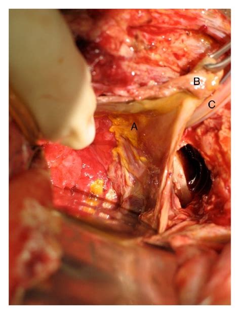 Key A Necrotic Tissue B Bladder Mucosa C Foley Catheter