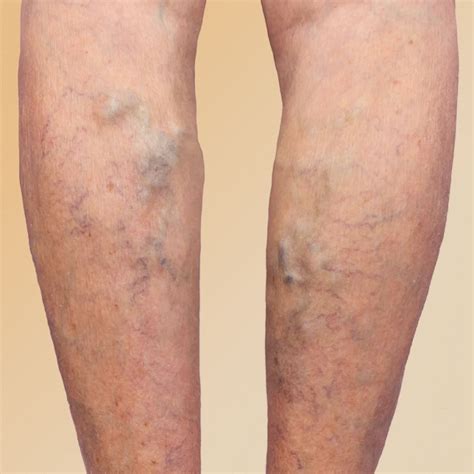 Varicose Veins Vs Spider Veins Key Differences You Should Know