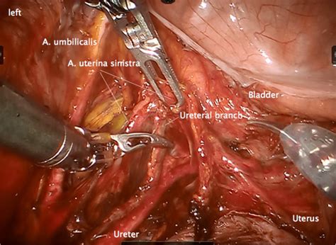 Elevation Of The Dissected Vascular Mesometrium And Dissection Of The
