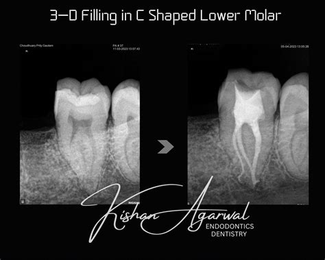 Dr Kishan Agarwal On Linkedin Endodontist Dentist Guwahati