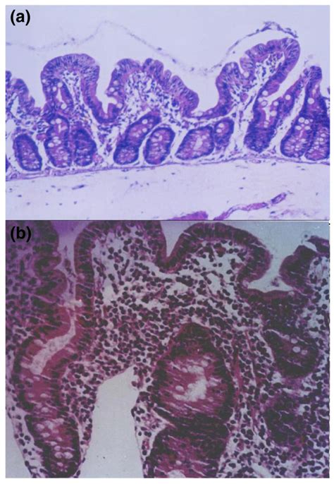 Intestinal Mucosa Showing Environmental Enteropathy A Biopsy Of The