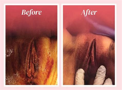 4 Things To Know About Labiaplasty Cangello Plastic Surgery