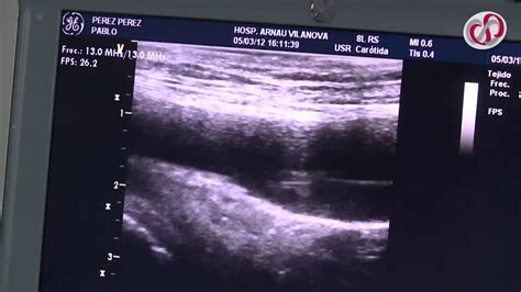 Examen de las arterias femorales ecografía femoral YouTube