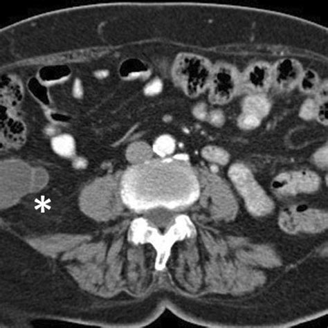 Ct Scan Showing Low Grade Appendiceal Mucinous Neoplasms With Liquid Download Scientific