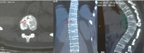 A Case Of Scheuermanns Disease Co Occurrence With Idiopathic Scoliosis And Intradural
