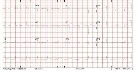 Subtle St Elevation Rreadmyecg