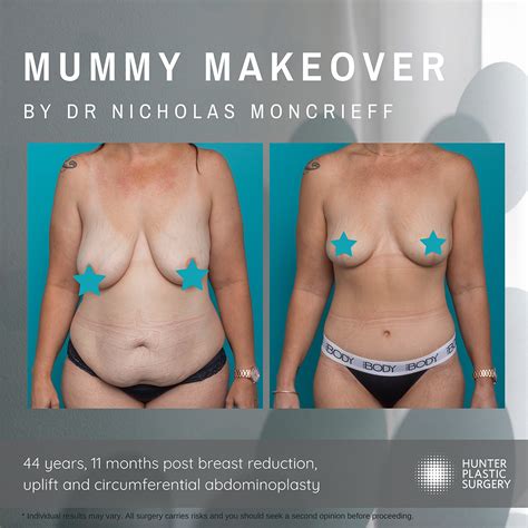 Before And After Plastic Surgery Breast Reduction