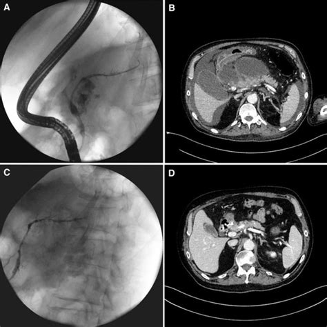 Complete Disruption Of The Main Pancreatic Duct In A Patient With