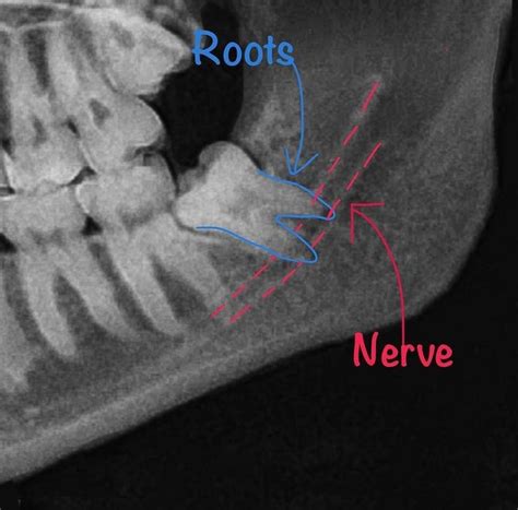 Coronectomy The Partial Tooth Removal — Elite Oral And Facial Surgery