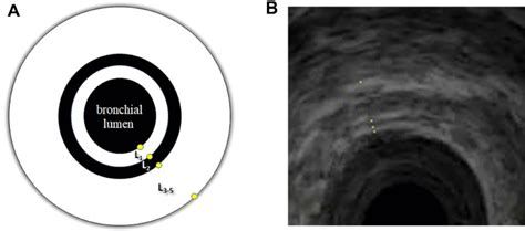 A Outline Of Bronchial Wall Layers B Schematic Measurement The Download Scientific Diagram