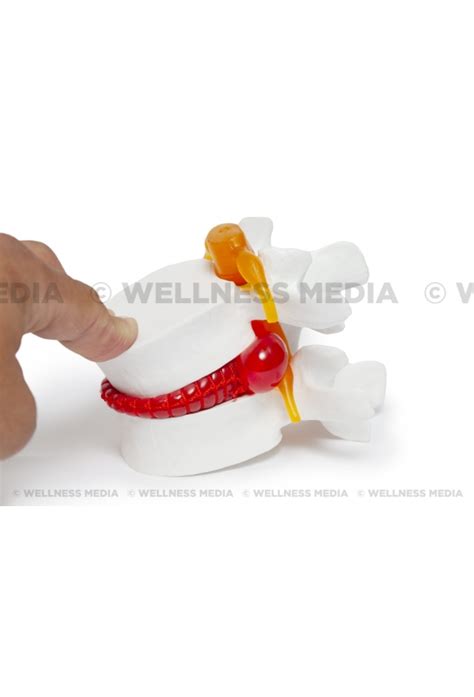 Lumbar Spine Disc Herniation Anatomical Model