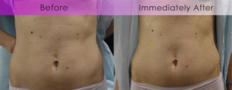 Abdominal Skin Tightening San Franciscos Dr Sheena Kong Describes