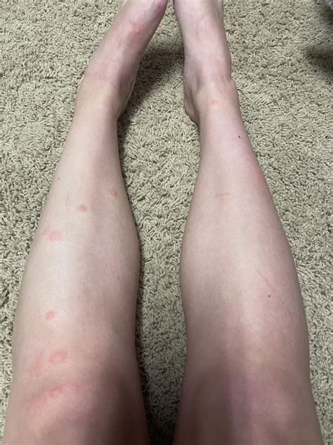 Flea Vs Mosquito Bites Rbugbites