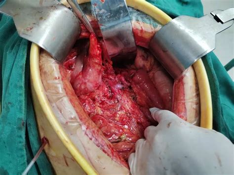 邵永孚教授：一例胰腺癌的精细复杂手术，既切除肿瘤，又尽可能保留了胰腺的内外分泌腺功能