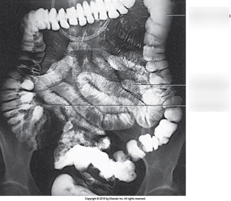 Figure Enteroclysis Procedure With Barium Visualized In Colon