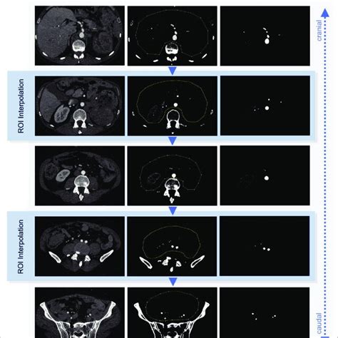 Process Of Roi Interpolation In Segmenting Vascular Structures Based Download Scientific