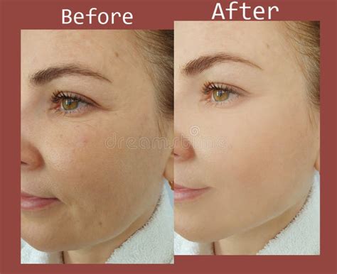 Woman Face Wrinkle Before And After Patient Treatment Double Chin