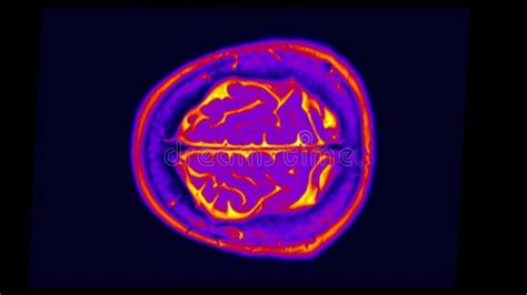 Human Brain Scan Mri Brain Scan Computed Tomography Of The Human