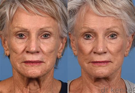 Neck Lift Before And After Pictures Case 338 Dallas Frisco Mckinney