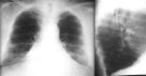 고대 연구팀 살 안 쪄도 심장주변 지방 많으면 심장병 빨간불