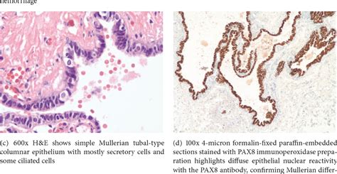 Figure 1 From Robot Assisted Thoracoscopic Resection Of A Posterior
