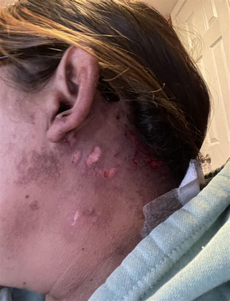 Shingles Around Ear And Neck Rshingles