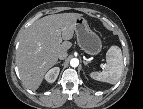 Nutcracker Syndrome Radiopaedia 57024 63896 A Nc Commons