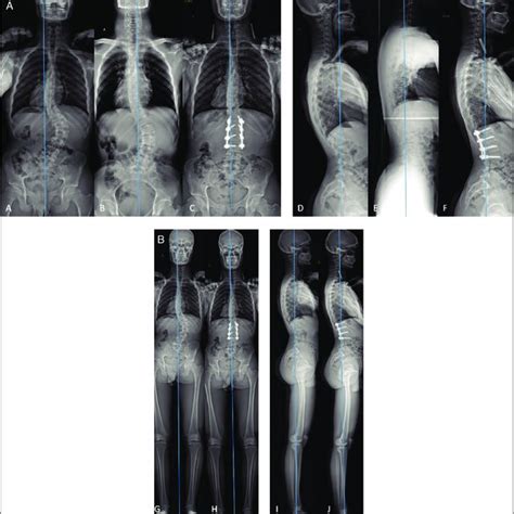 Patient Presenting With A Lenke Type 1a Curve On The Ap Standing