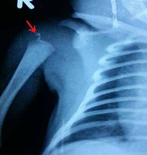 Stippling Of Right Humeral Epiphysis Download Scientific Diagram