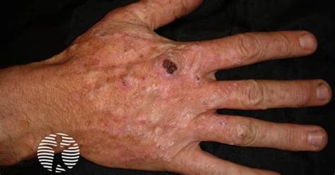 Actinic Keratoses Affecting The Hands Image