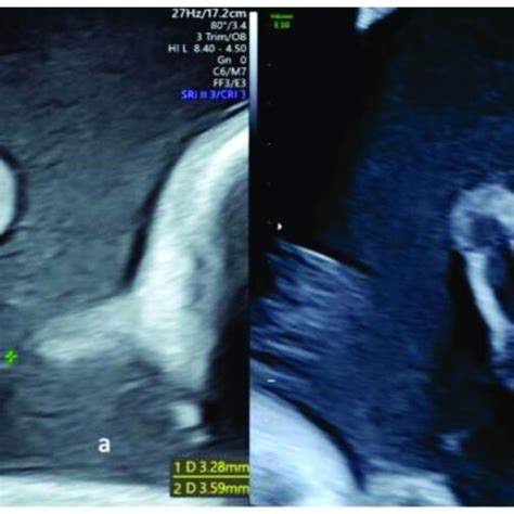 Ultrasound Views Of A Free Umbilical Cord In Fetuses With A Regular