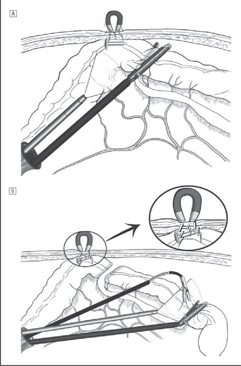 Sigmoid Colectomy Semantic Scholar