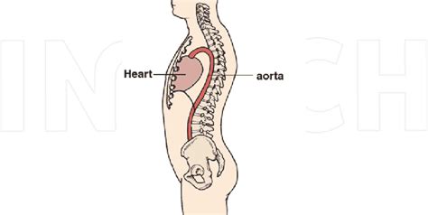 Figure 1 From Numerical Simulation In Aortic Arch Aneurysm Semantic