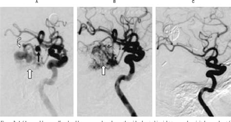 Figure 1 From Supratentorial Brain Avm Embolization With Onyx 18 And