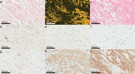 Congo Red And Immunostaining Of Attr Deposits Of Heart Tissue Congo Red