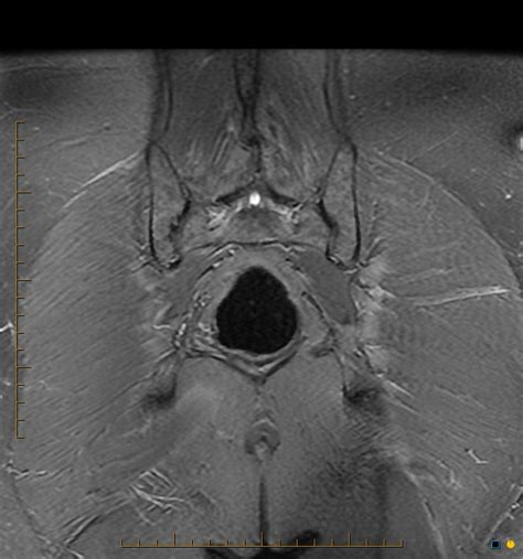 Radiopaedia Case Mri Artifact Flow Void Between Urinary Bladder And