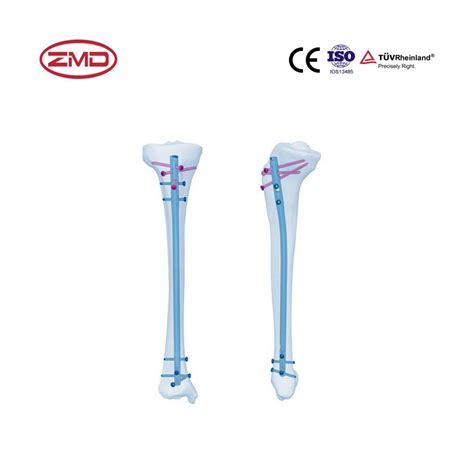 Tibia Lockable Intramedullary Nail Pharmaceutical Company