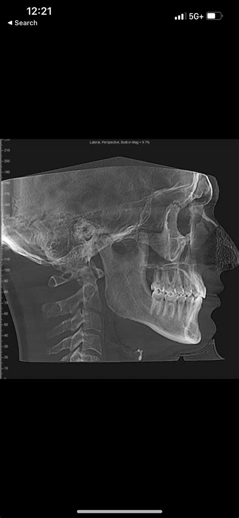 Need Jaw Surgery For Osa What Are The Aesthetic Implications R