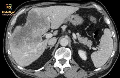 Mass Forming Cholangiocarcinoma Radiology Case Radiogyan